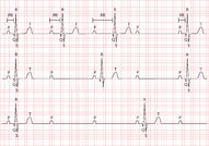 Option 2: Stable bradycardia - Knowledge @ AMBOSS