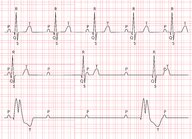 ECG - Knowledge @ AMBOSS