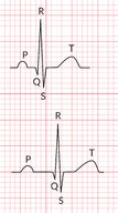 Risk of progression to complete heart block : low, as the block results ...