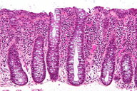 Microscopic colitis - Knowledge @ AMBOSS