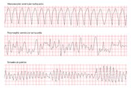 Ventricular tachycardia - Knowledge @ AMBOSS