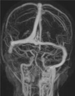Cerebral venous thrombosis - Knowledge @ AMBOSS