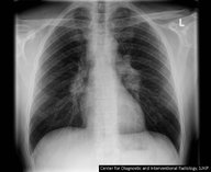 Sarcoidosis - Knowledge @ AMBOSS