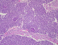 Nephroblastoma - Knowledge @ AMBOSS