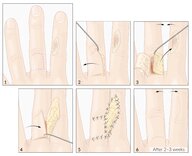 Acute wounds - Knowledge @ AMBOSS