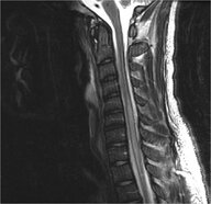 Multiple sclerosis - Knowledge @ AMBOSS