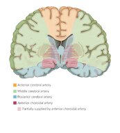 Overview of stroke - Knowledge @ AMBOSS