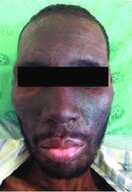 Photodermatoses - Knowledge @ AMBOSS