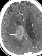 Option 2: Hemorrhagic stroke - Knowledge @ AMBOSS