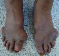 Gout and hyperuricemia - Knowledge @ AMBOSS