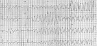 Ventricular tachycardia - Knowledge @ AMBOSS
