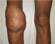 Tuberculosis - Knowledge @ AMBOSS