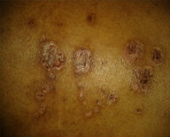 Systemic lupus erythematosus - Knowledge @ AMBOSS