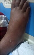 Peripheral edema - Knowledge @ AMBOSS