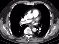Pulmonary hypertension and cor pulmonale - Knowledge @ AMBOSS