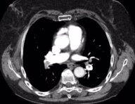 Atrial fibrillation - Knowledge @ AMBOSS