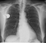 Cardiac implantable electronic devices - Knowledge @ AMBOSS