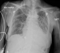 Nasogastric tube placement - Knowledge @ AMBOSS