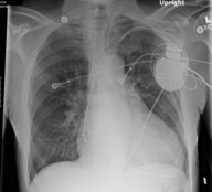 Cardiac implantable electronic devices - Knowledge @ AMBOSS