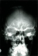 Skull fractures - Knowledge @ AMBOSS