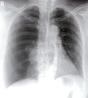 Pneumothorax - Knowledge @ AMBOSS