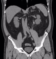 Urinary tract obstruction - Knowledge @ AMBOSS