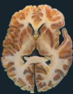 The cerebral cortex, meninges, basal ganglia, and ventricular system ...