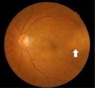 Diseases of the uvea - Knowledge @ AMBOSS