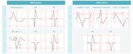 Ventricular tachycardia - Knowledge @ AMBOSS