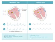 Supraventricular tachycardia - Knowledge @ AMBOSS