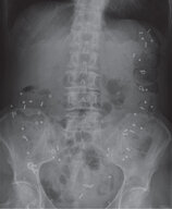 Megacolon - Knowledge @ AMBOSS