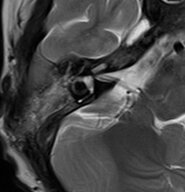 Mastoiditis - Knowledge @ AMBOSS
