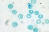 Hemolytic anemia - Knowledge @ AMBOSS