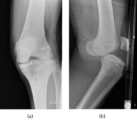 Knee ligament injuries - Knowledge @ AMBOSS