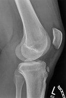 Osgood-Schlatter disease - Knowledge @ AMBOSS