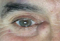 Eye pain and red eye - Knowledge @ AMBOSS