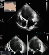 Second most common cardiomyopathy Most common cause of sudden heart ...