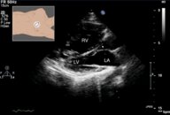 Pulmonary hypertension and cor pulmonale - Knowledge @ AMBOSS