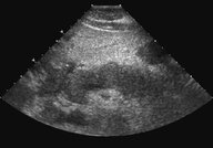 Acute pancreatitis - Knowledge @ AMBOSS
