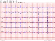 Option 2: Stable bradycardia - Knowledge @ AMBOSS