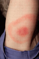 Lyme disease - Knowledge @ AMBOSS