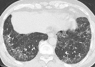Systemic sclerosis - Knowledge @ AMBOSS