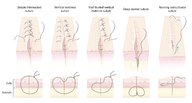 Wound closure techniques - Knowledge @ AMBOSS