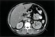 Perinephric abscess - Knowledge @ AMBOSS