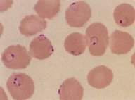 Hemolytic anemia - Knowledge @ AMBOSS