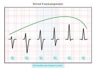 ECG - Knowledge @ AMBOSS