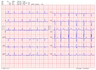 Atrial fibrillation - Knowledge @ AMBOSS