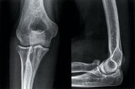 Olecranon fracture