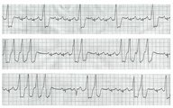 Cardiovascular drug poisoning - Knowledge @ AMBOSS