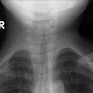 Bacterial tracheitis - Knowledge @ AMBOSS